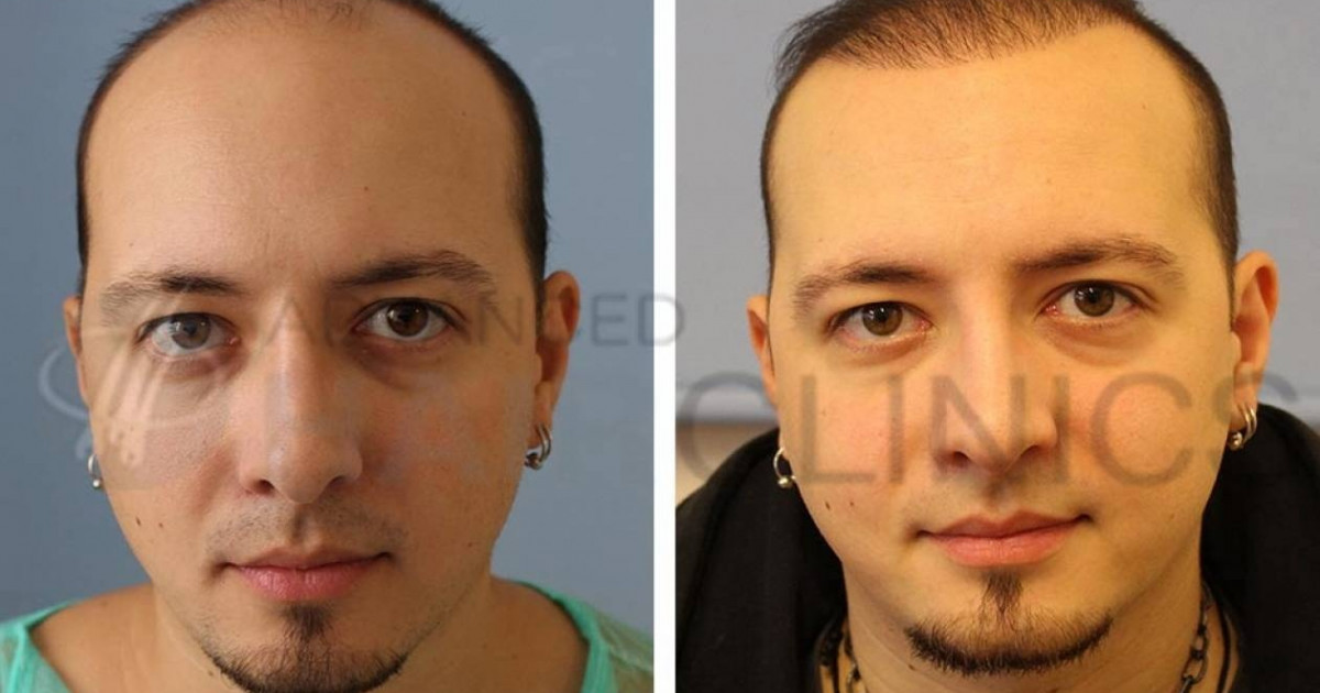 Πώς είναι ο Steve Tesser 5 μήνες μετά την εμφύτευση μαλλιών; - Newsbomb