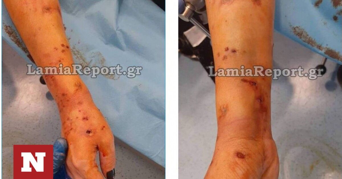Λαμία: Ξεκίνησε να πάει στη δουλειά και βρέθηκε στο νοσοκομείο – Άγρια ...