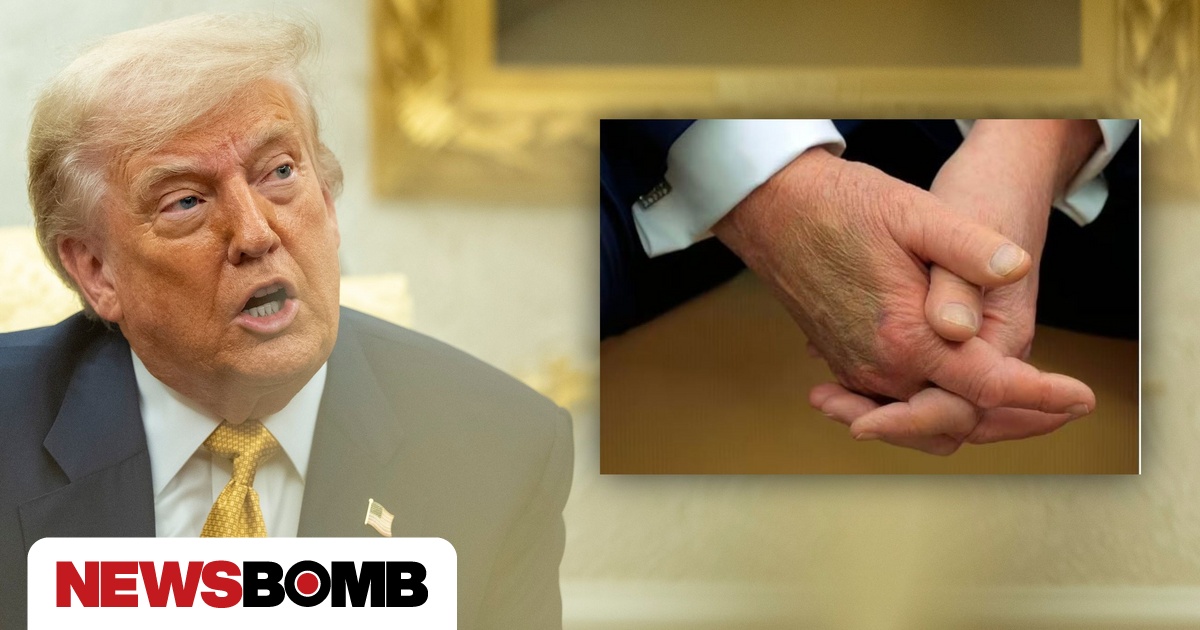 Tραμπ: H νόσος που τον «ταλαιπωρεί» και η επιστολή του γιατρού του - Newsbomb