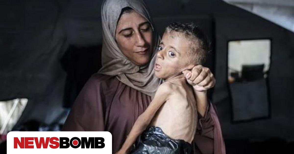 Διορθώνουν οι New York Times: Ο υποσιτισμένος μικρός Μοχάμεντ από τη Γάζα «έχει και άλλη πάθηση ...